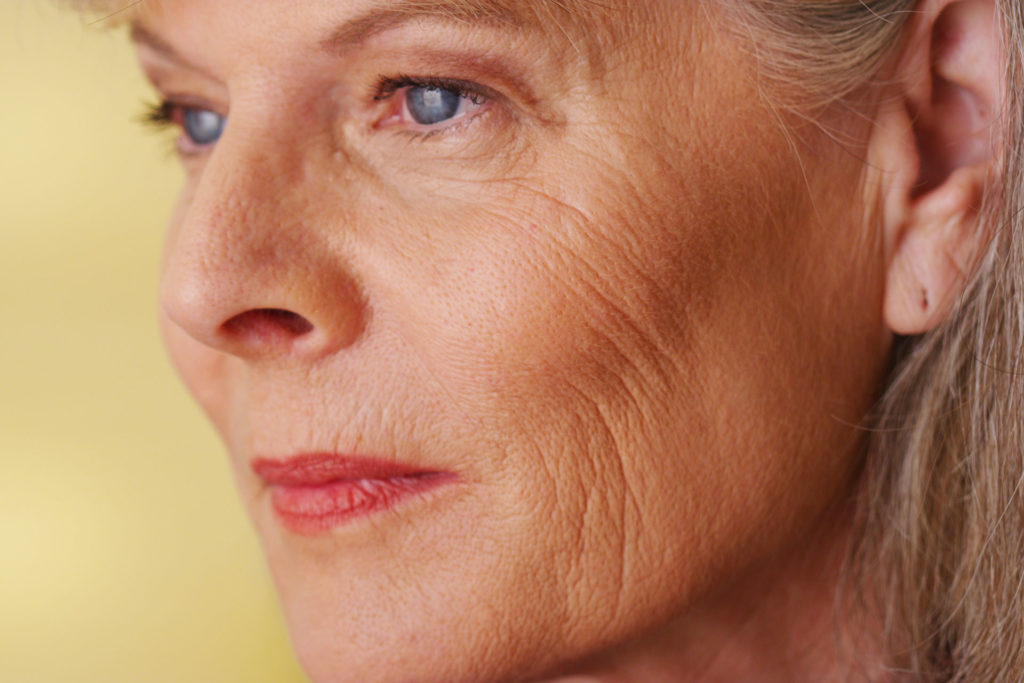 Ridules autour des lèvres - Médecine esthétique et vasculaire - Dr ...