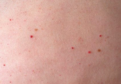 Angiome - Médecine esthétique et vasculaire - Dr Gandillet